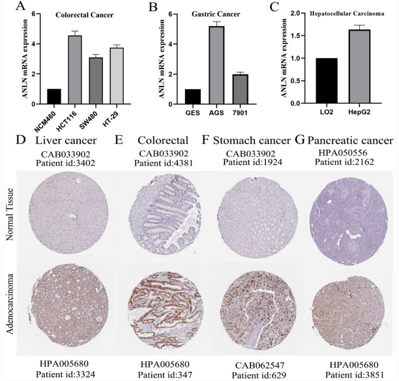 Our Anti-ANLN polyclonal antibodies in research on various types of cancer